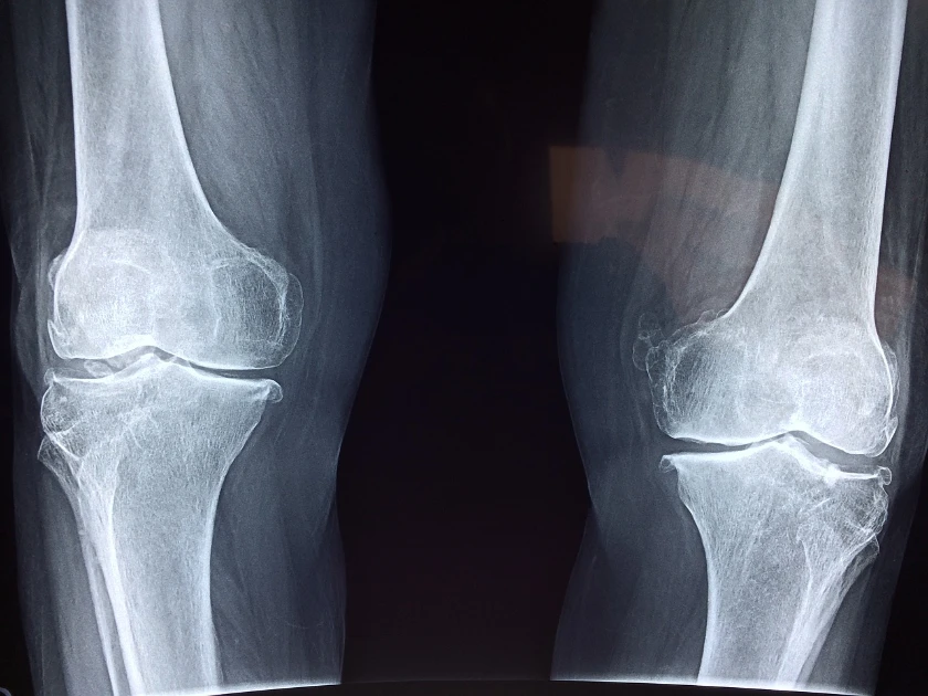 Orthofix Medical Reports Second Quarter Loss Amid Revenue Growth