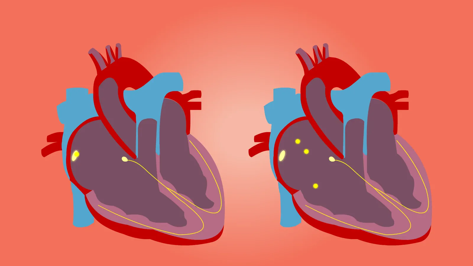 Kestra Medical Q3 2026: Cardiac System Saves Patient During Holiday Crisis