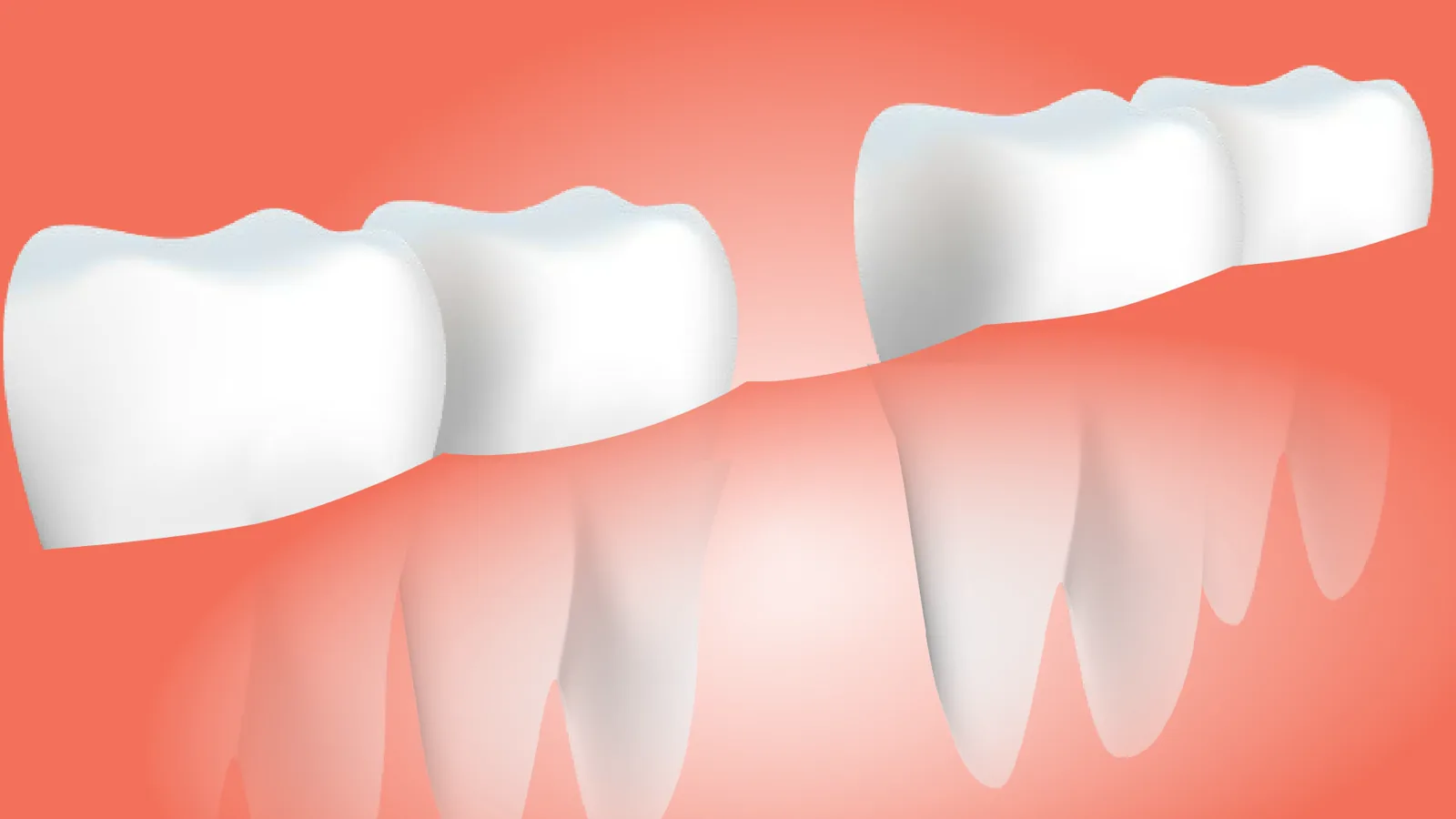 Stratasys TrueDent Dental Resins Achieve CE Class IIa Medical Device Certification